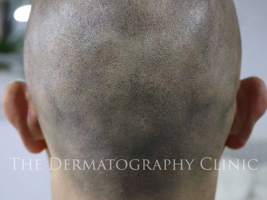 Alopecia In Men - Alopecia Camouflage The Treatment