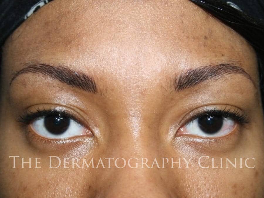 Alopecia In Women - The Dermatography Clinic