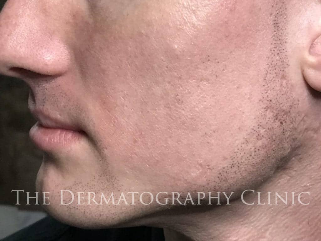 Alopecia In Men - The Dermatography Clinic