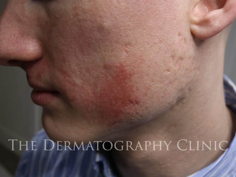 Alopecia In Men - The Dermatography Clinic