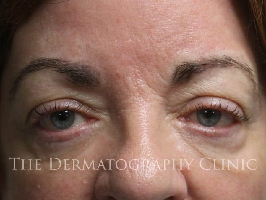 Alopecia In Women - The Dermatography Clinic