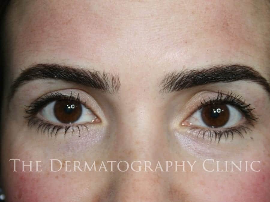 Permanent Eyebrows - The Dermatography Clinic