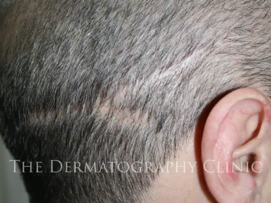 Beard Tattoo For Men - The Dermatography Clinic