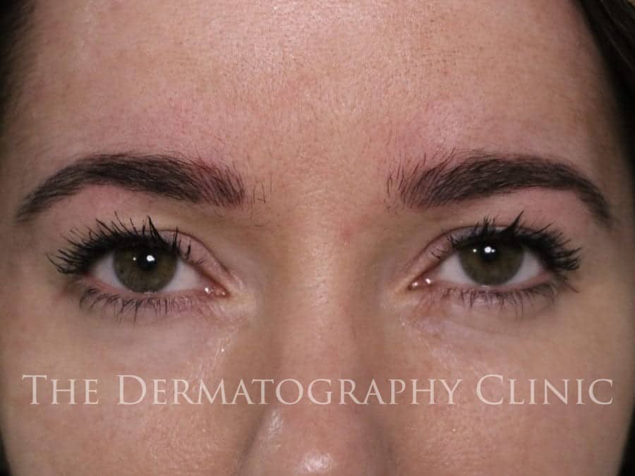 Permanent Eyebrows - The Dermatography Clinic