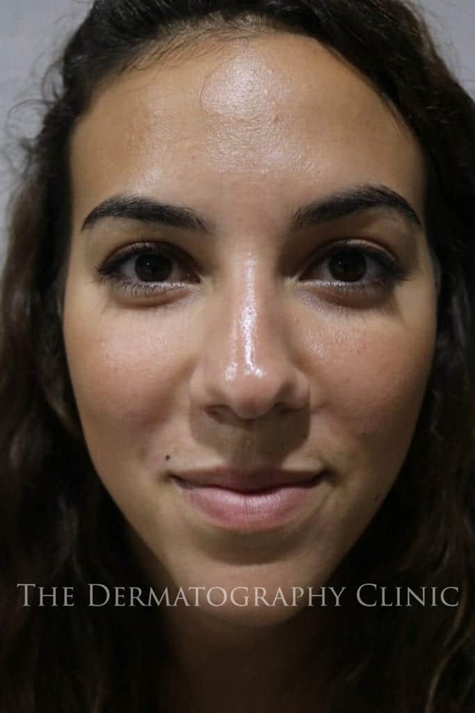 Beauty Spot Tattoo - The Dermatography Clinic