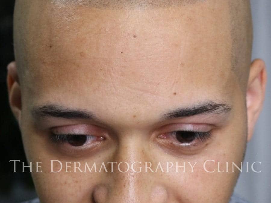 SMP (Scalp Micropigmentation) - The Dermatography Clinic