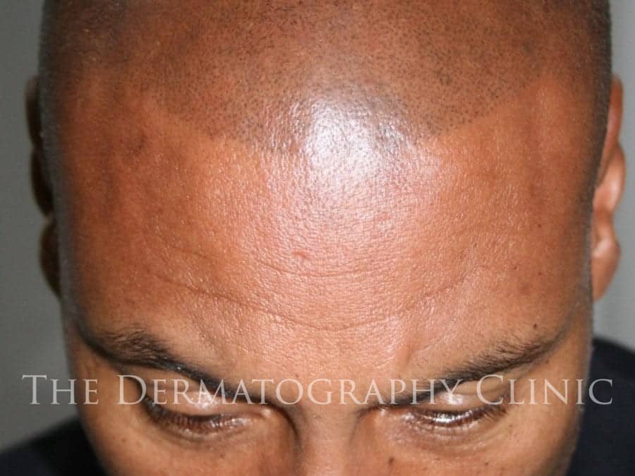 SMP (Scalp Micropigmentation) - The Dermatography Clinic