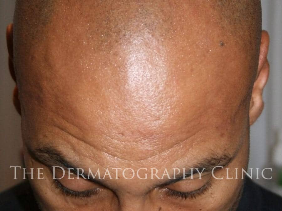 SMP (Scalp Micropigmentation) - The Dermatography Clinic