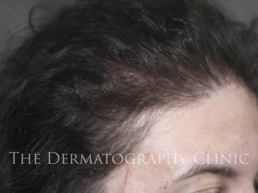 Scalp Micropigmentation For Women - The Dermatography Clinic