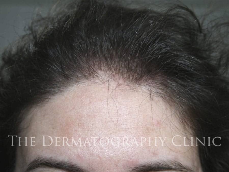 Scalp Micropigmentation For Women - The Dermatography Clinic