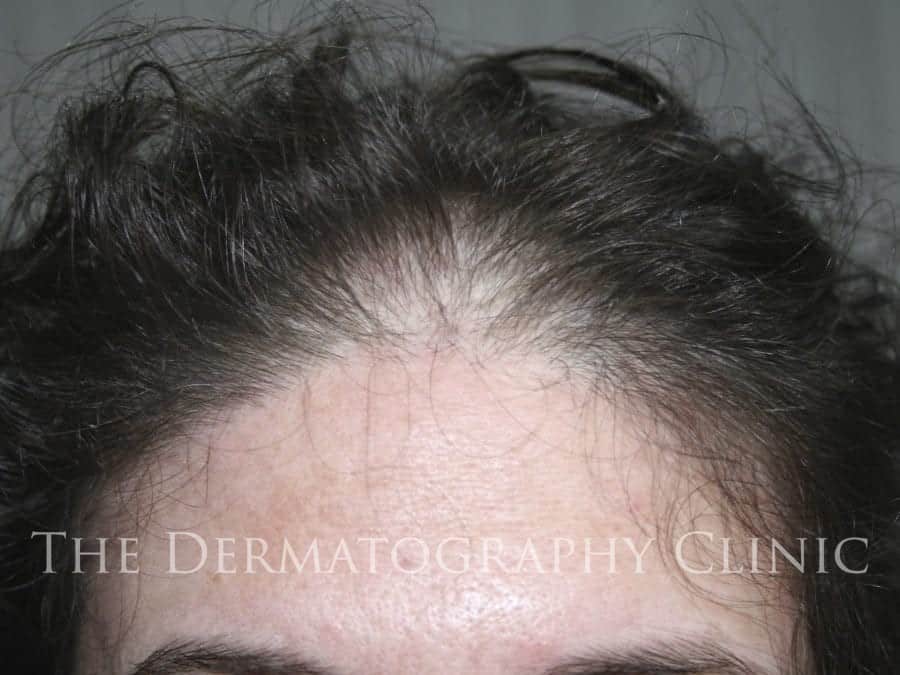 Scalp Micropigmentation For Women - The Dermatography Clinic