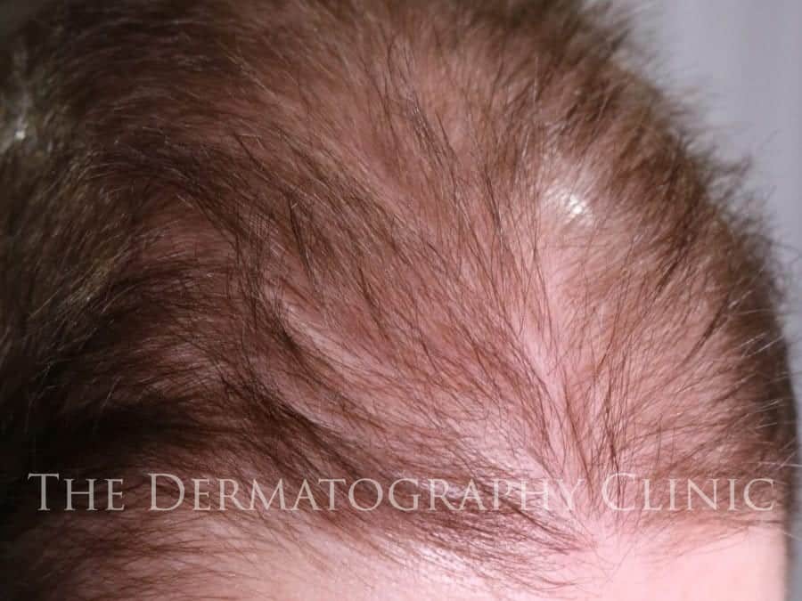 Scalp Micropigmentation For Women - The Dermatography Clinic