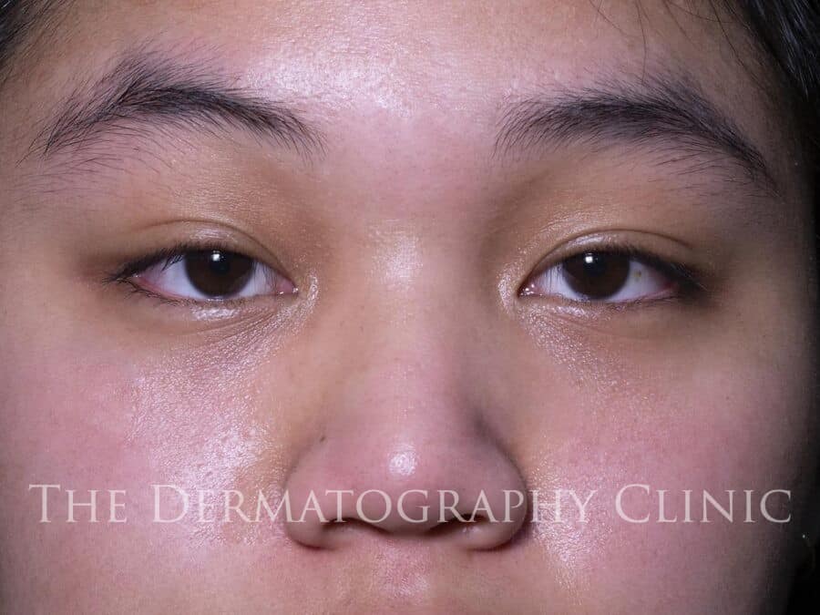 Permanent Eyebrows - The Dermatography Clinic
