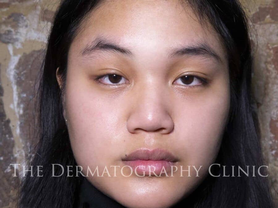 Permanent Eyebrows - The Dermatography Clinic