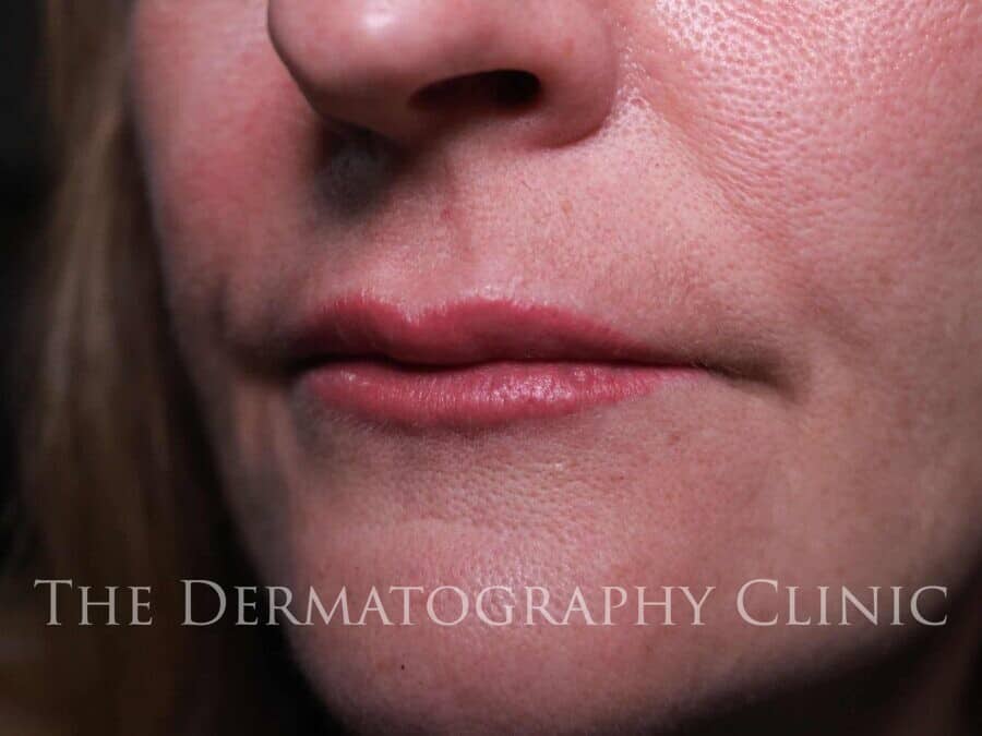 Lip Blush Tattoo - The Dermatography Clinic