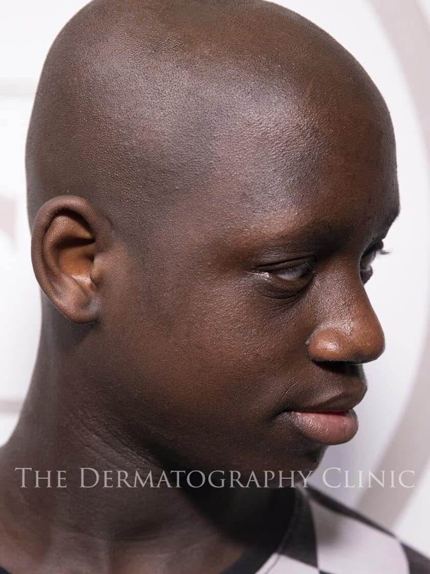 Alopecia In Men - Alopecia Camouflage The Treatment