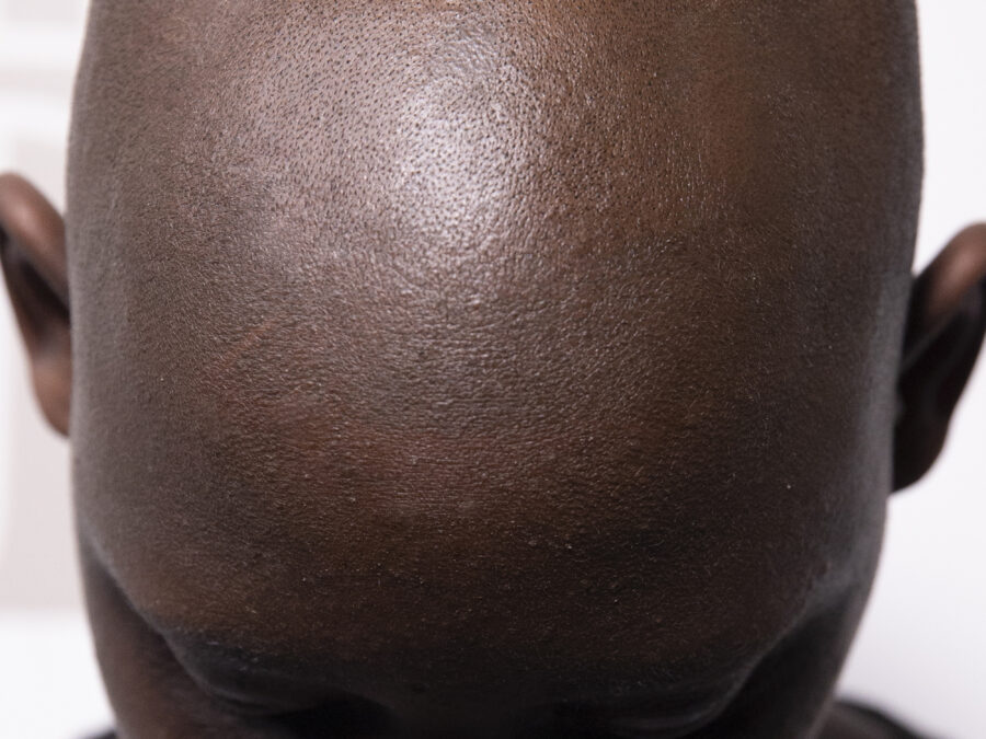 Alopecia In Men - The Dermatography Clinic