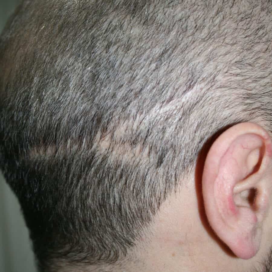 Beard Tattoo For Men - The Dermatography Clinic