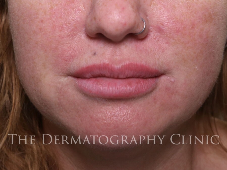 No Needle Dermal Fillers - The Dermatography Clinic