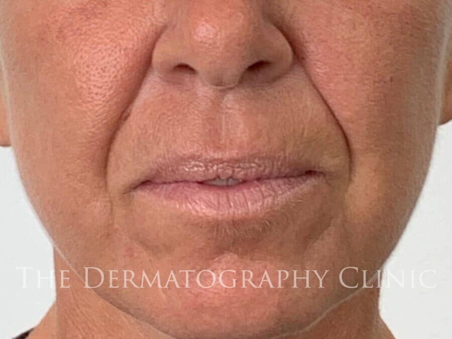 No Needle Dermal Fillers - The Dermatography Clinic