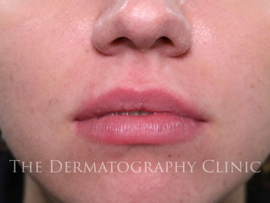 No Needle Dermal Fillers - The Dermatography Clinic
