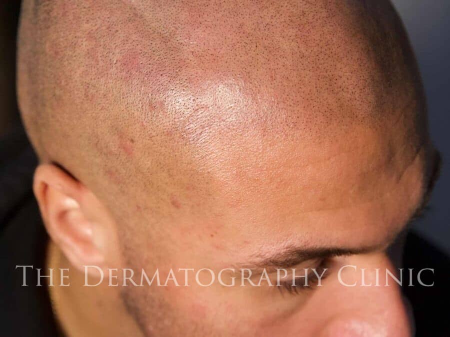 SMP (Scalp Micropigmentation) - The Dermatography Clinic