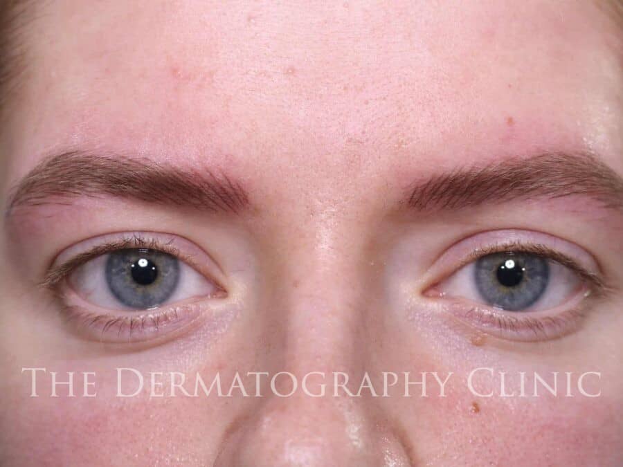 Permanent Eyebrows - The Dermatography Clinic