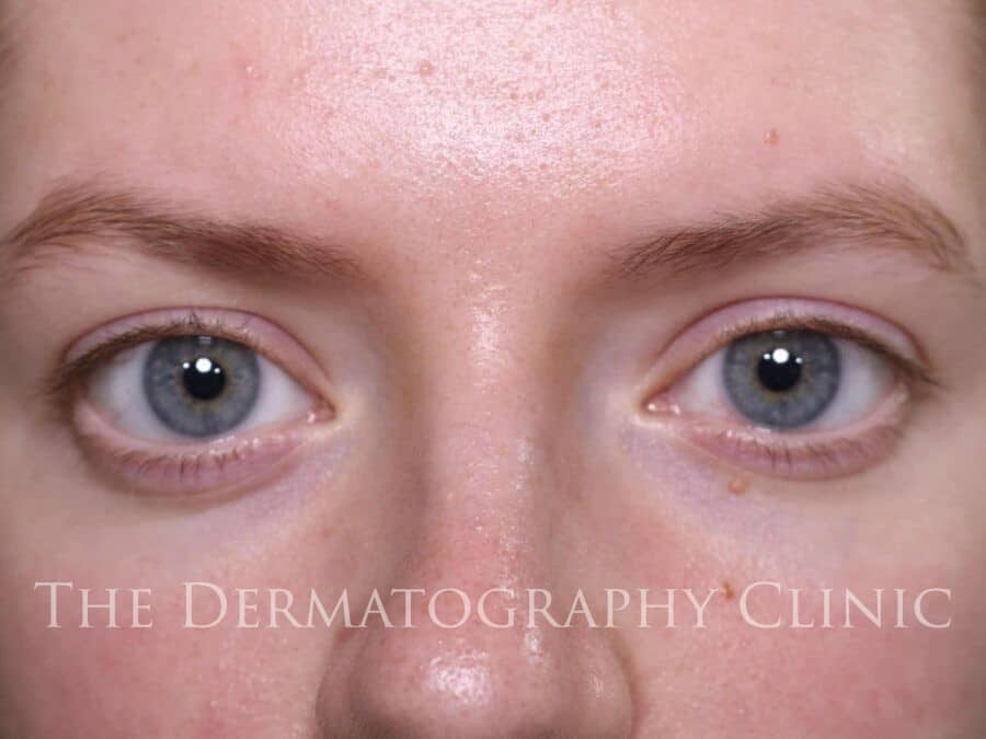 Permanent Eyebrows - The Dermatography Clinic