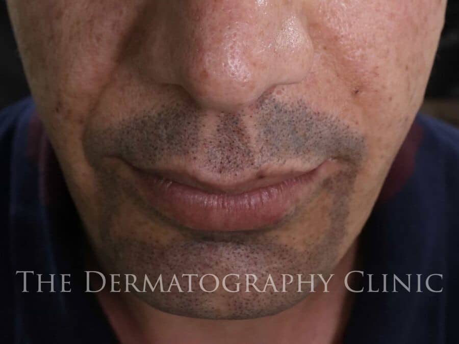 Scar Camouflage Tattoo - The Dermatography Clinic