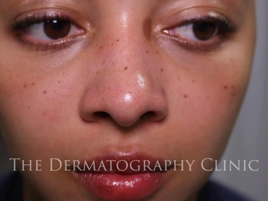 Scar Camouflage Tattoo - The Dermatography Clinic