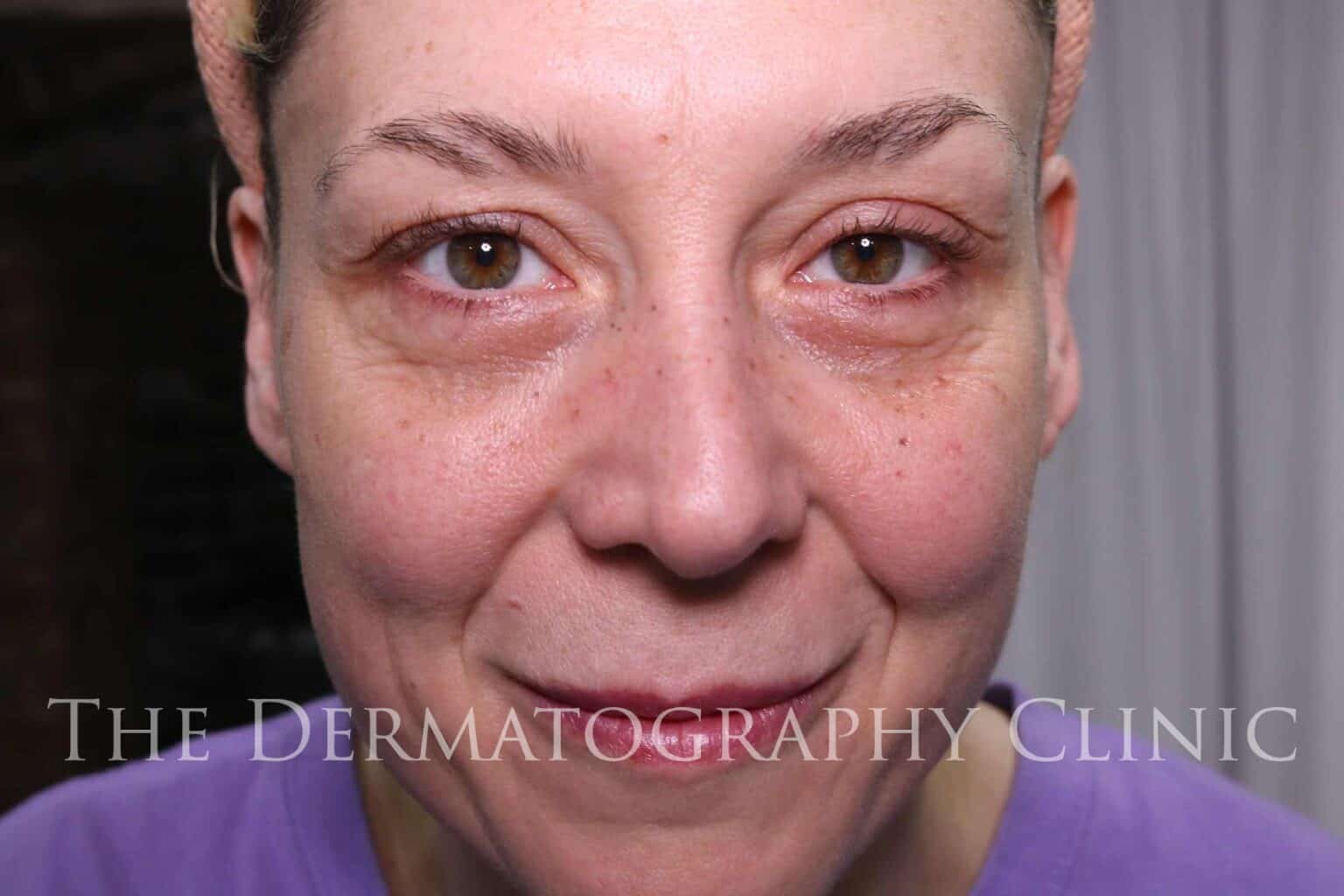 Freckle Tattoo - The Dermatography Clinic