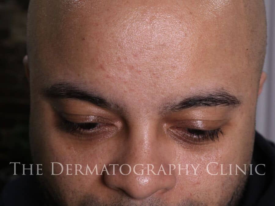 SMP (Scalp Micropigmentation) - The Dermatography Clinic