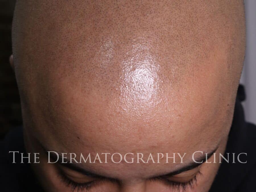 SMP (Scalp Micropigmentation) - The Dermatography Clinic