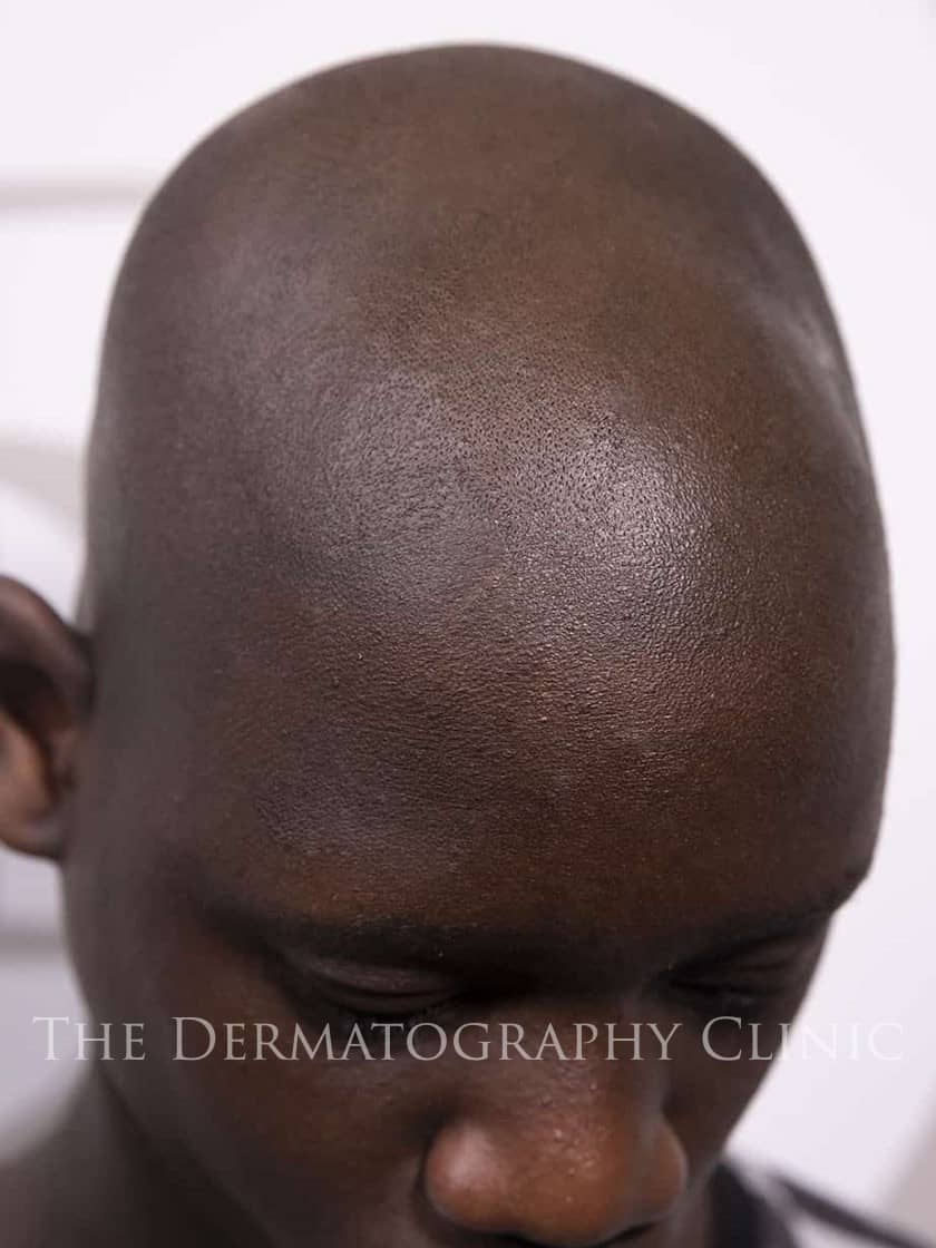 Alopecia In Men - Alopecia Camouflage The Treatment