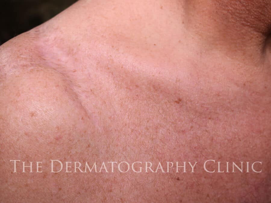 Scar Camouflage Tattoo - The Dermatography Clinic