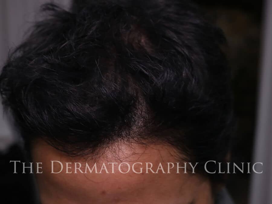 Scalp Micropigmentation For Women - The Dermatography Clinic