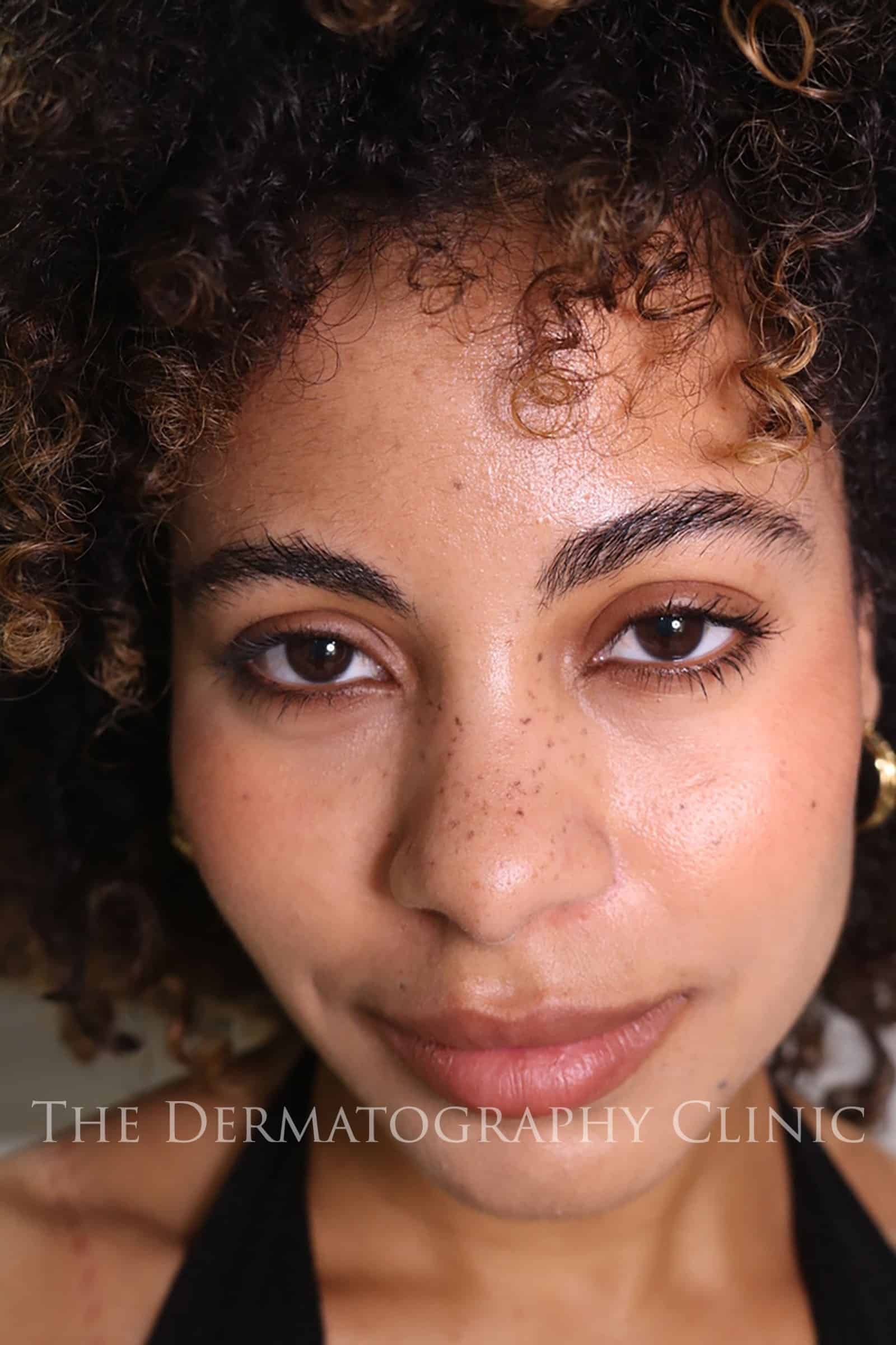 Freckle Tattoo - The Dermatography Clinic